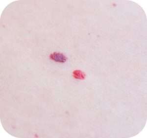Conditions – Parsons Dermatology & Cosmetics