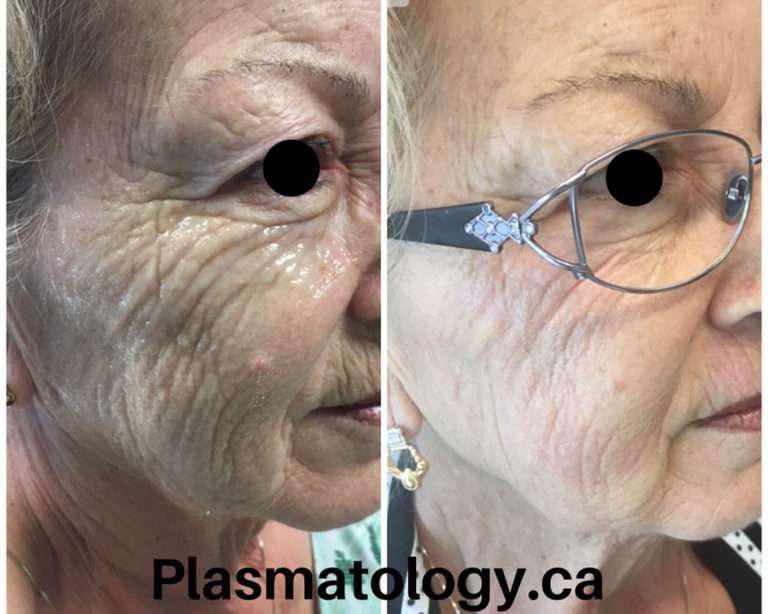 Plexr Plus – Parsons Dermatology & Cosmetics