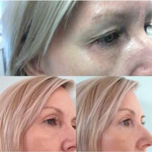 Plexr Plus – Parsons Dermatology & Cosmetics