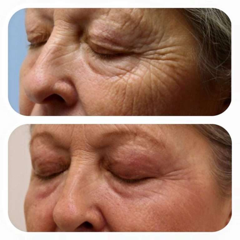 Plexr Plus – Parsons Dermatology & Cosmetics